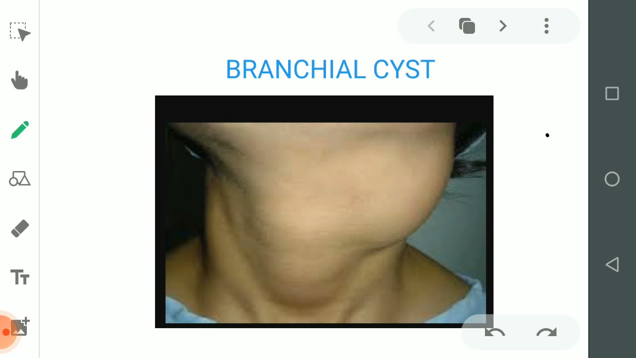 BRANCHIAL CYST||SWELLINGS OF THE NECK|| SIMPLE AND EASY#like #swellings ...