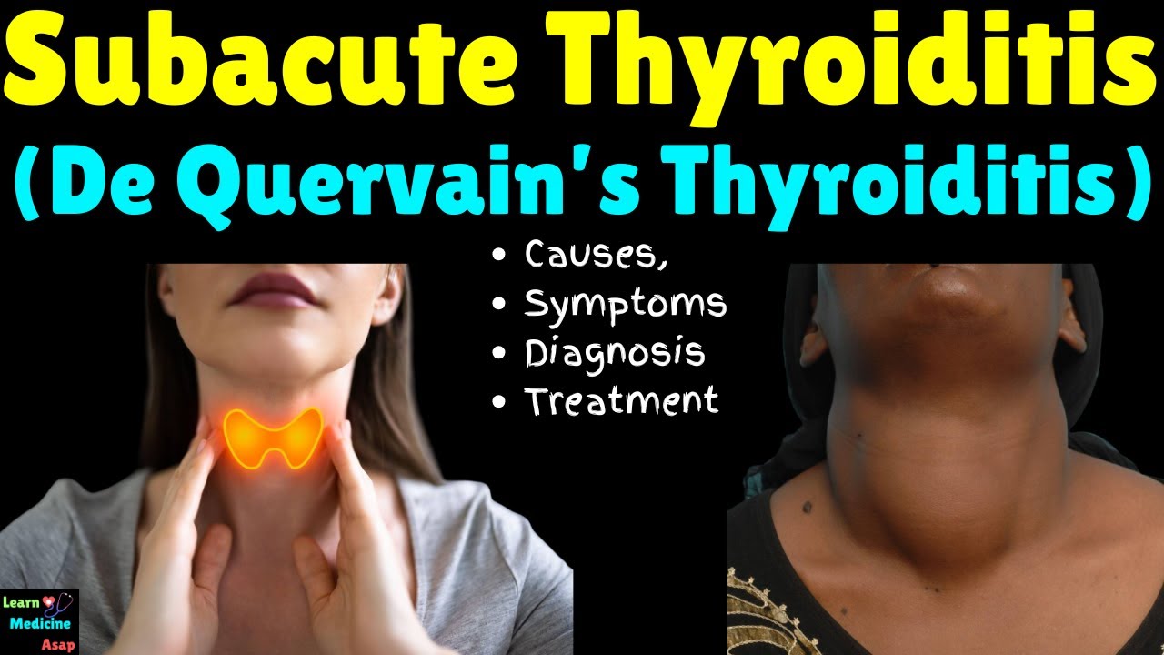 Subacute Thyroiditis (De Quervain’s Thyroiditis) – Causes, Symptoms ...