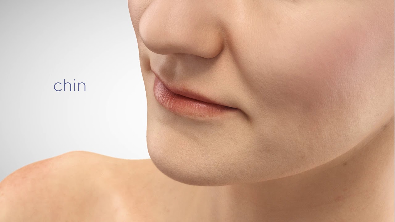 Restylane - Nasha & OBT technologies - YouTube