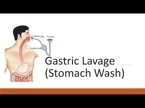 Gastric Lavage/ Stomach Wash - YouTube