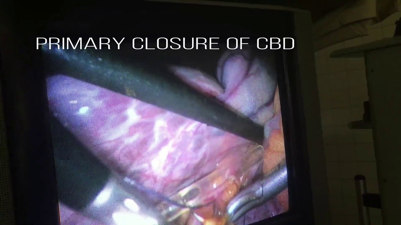 Laparoscopic Choledocholithotomydrjahangir Youtube