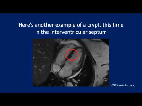 One Minute #CardioEd: Myocardial crypts in HCM - YouTube