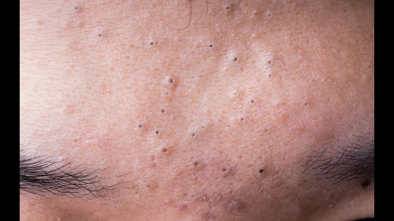 Acne and blackhead removal - YouTube