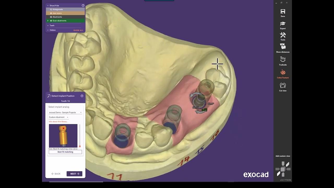 Exocad custom abutment 1st video (Scan body) - YouTube