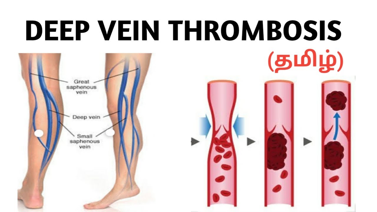 Deep Vein Thrombosis | Causes | Risk factor | Symptoms | Treatment ...
