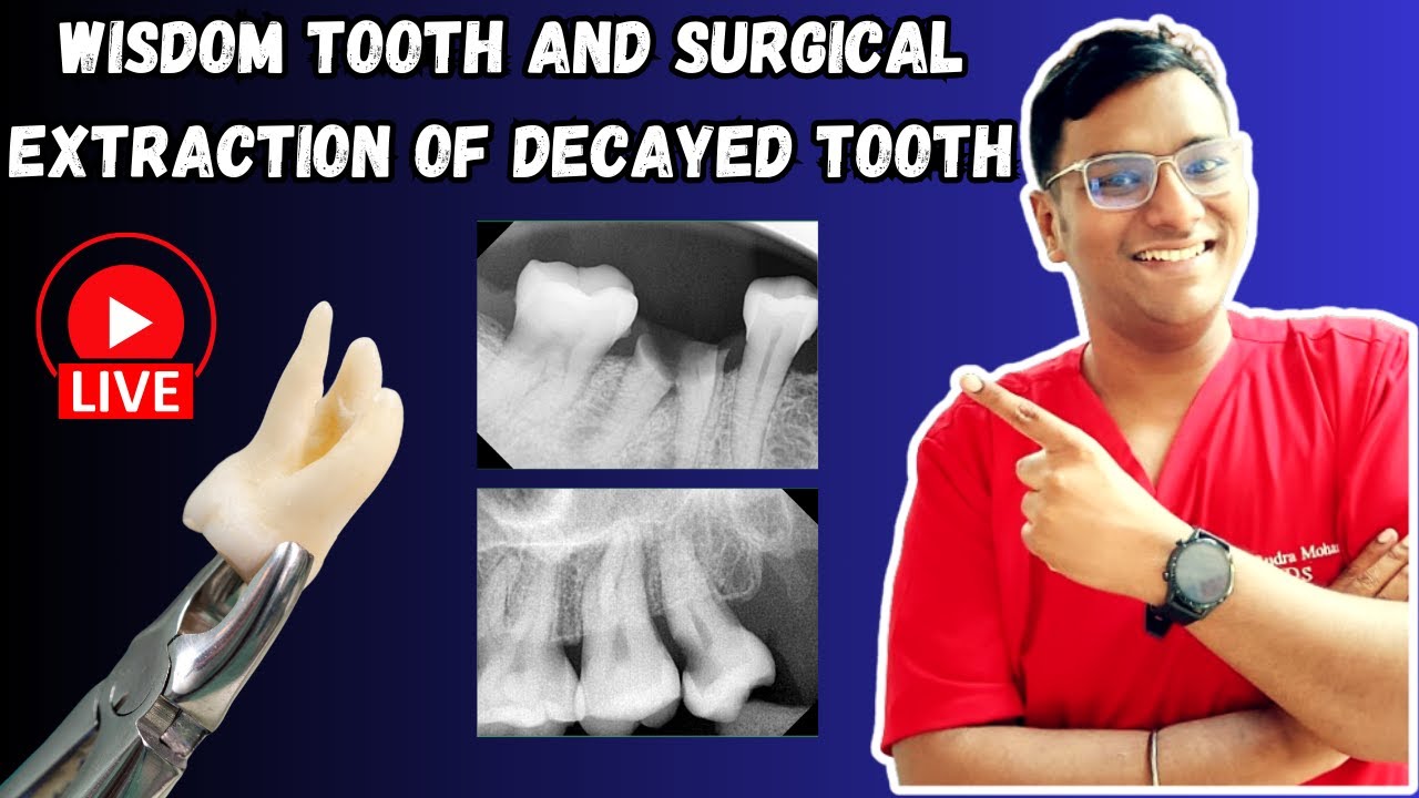 Dr Rudra Mohan | Wisdom Tooth Extraction and Surgical Extraction of ...