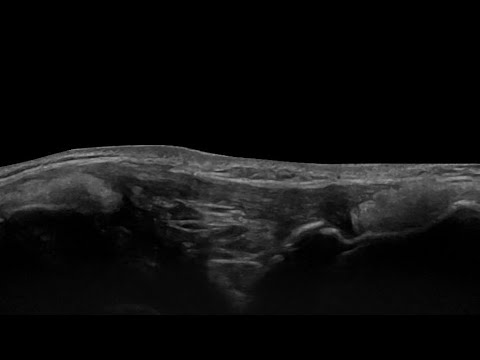 Ultrasound appearance of… patellar tendon graft for ACL repair - YouTube