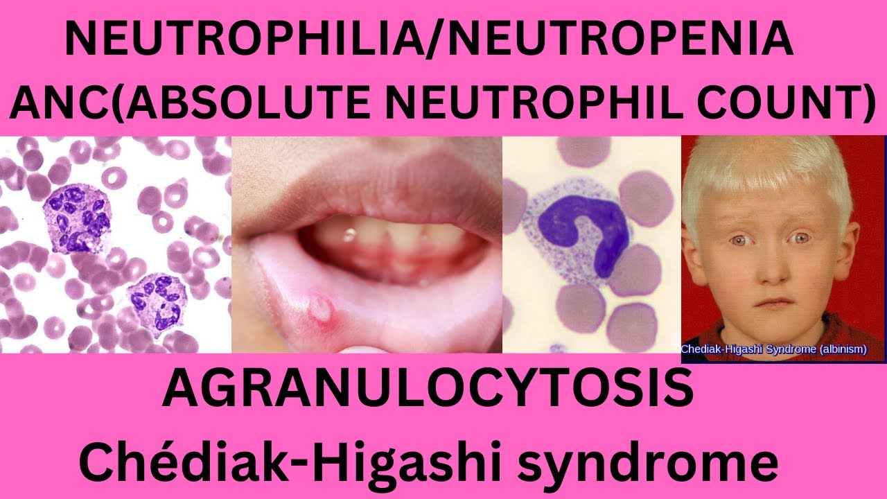 NEUTROPHILS,ABOSOLUTE NEUTROPHIL COUNT(ANC),NEUTROPHILA,NEUTROPENIA ...