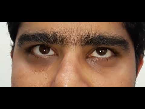 Artificial Eye Movement {Custom Made Artificial Eye} Global Prosthetic ...
