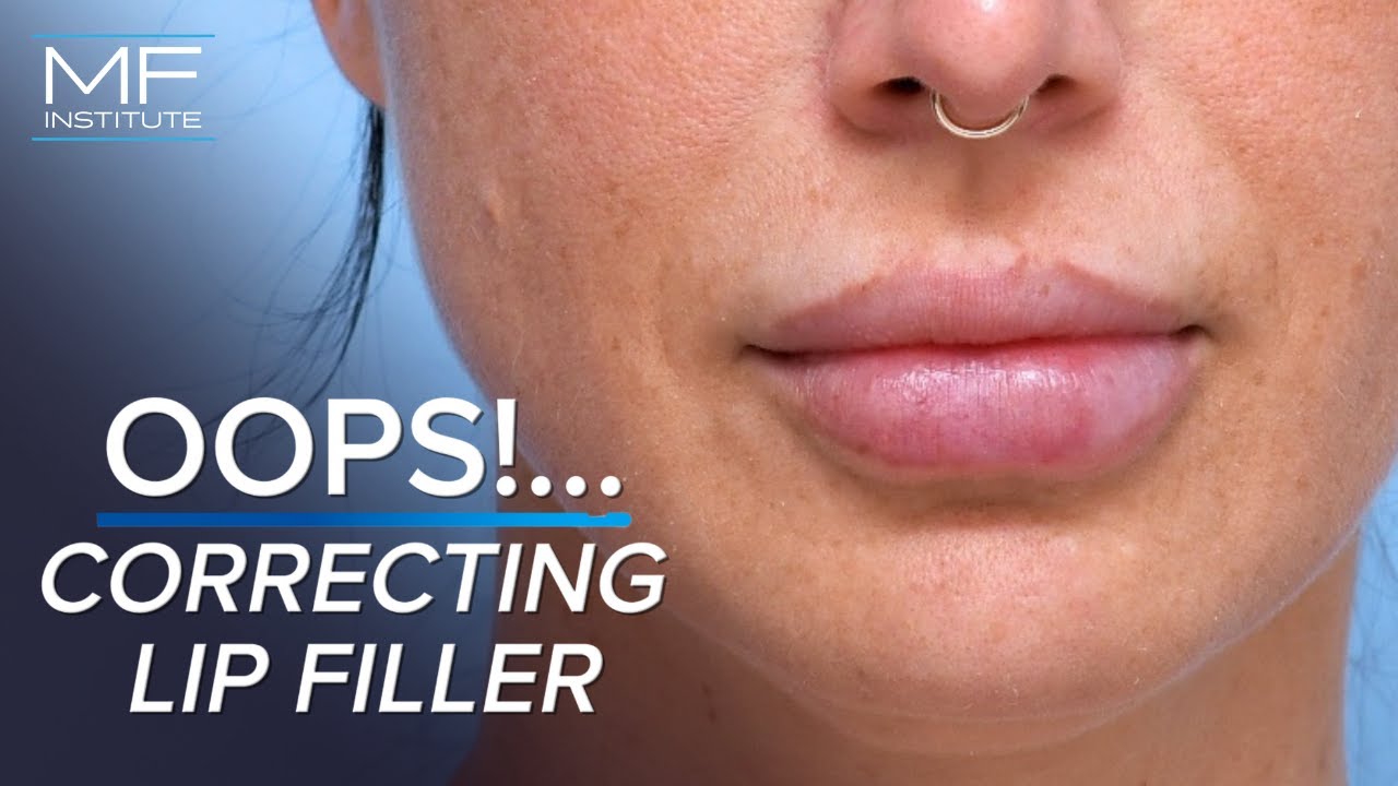 Can You Dissolve Lip Filler? Let's Talk About Your Options! | Mabrie ...