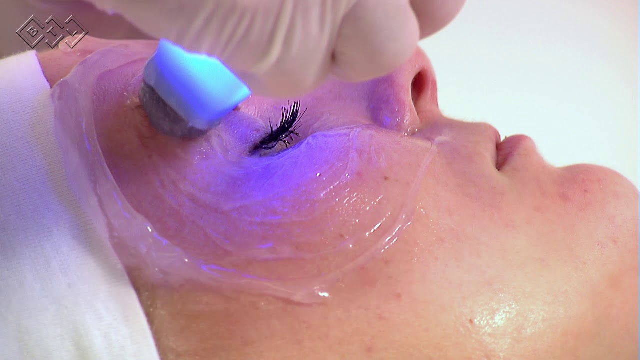 Tratamiento de zona periocular con Exilis Elite - YouTube
