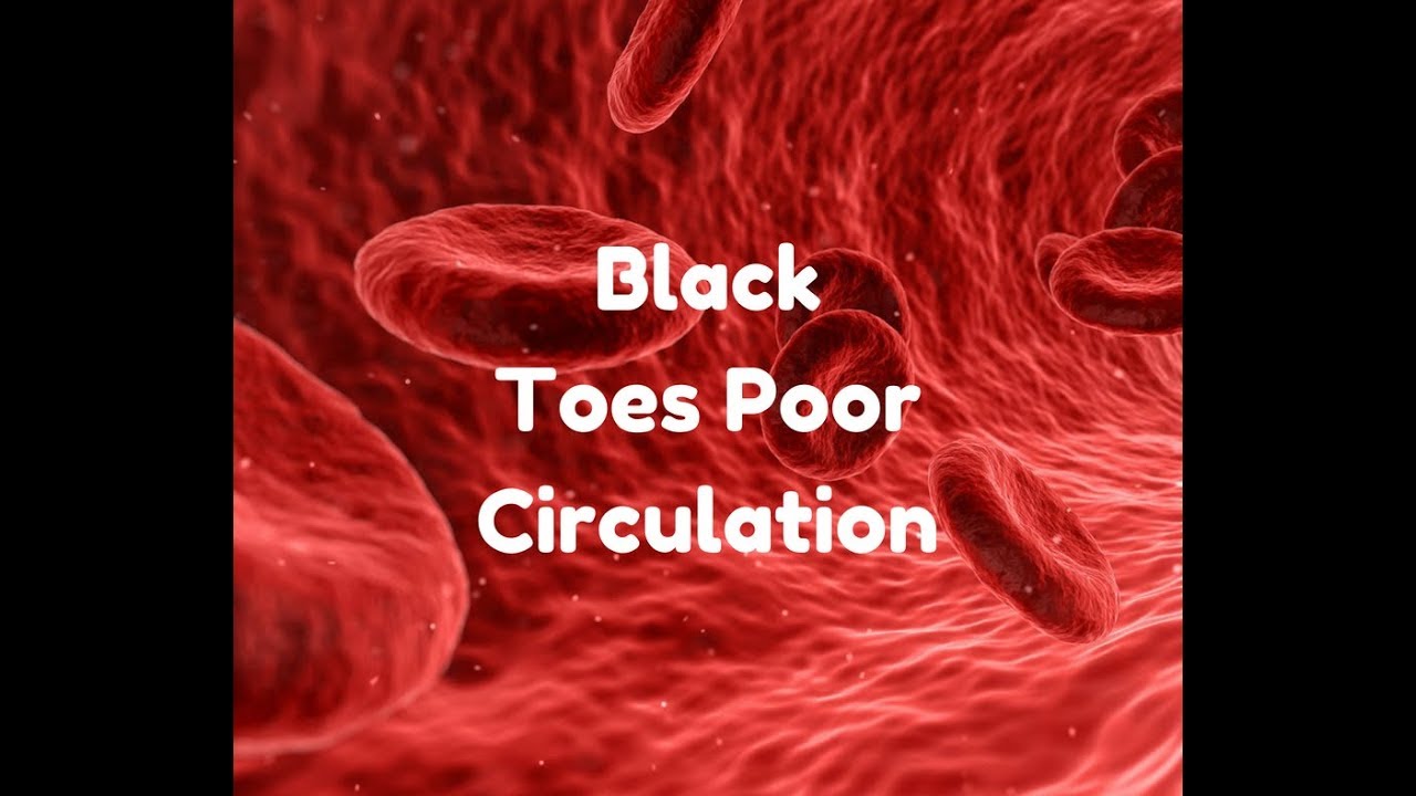 black toes poor circulation - YouTube