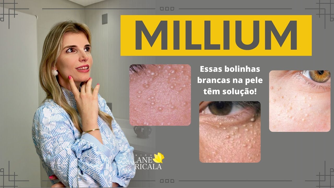 Como Tirar Milium Sem Machucar a Pele? - YouTube