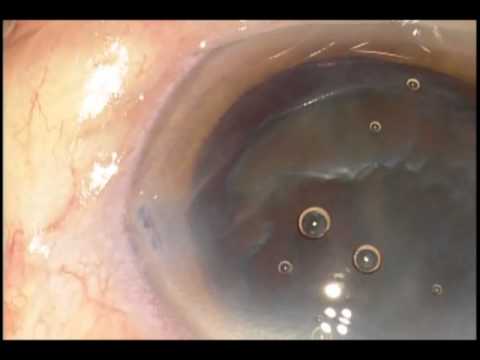 Luxacion del nucleo con hidro y visco - YouTube