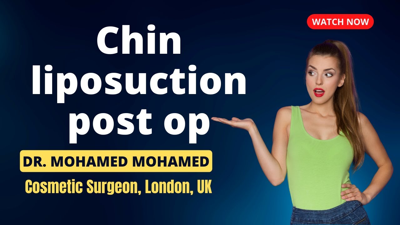 Chin liposuction post op - Dr. Mohamed Mohamed, Chin Liposuction ...