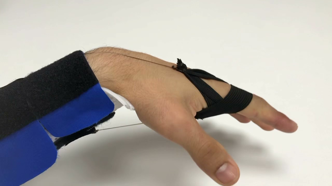 Splint to enhance tenodesis effect - YouTube