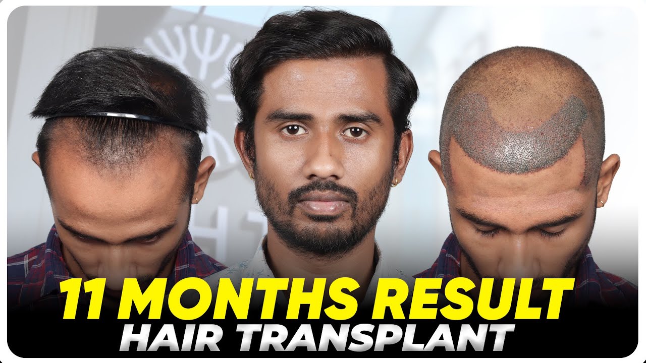 Hair Transplant in Hubli | Best Results & Cost of Hair Transplant in ...
