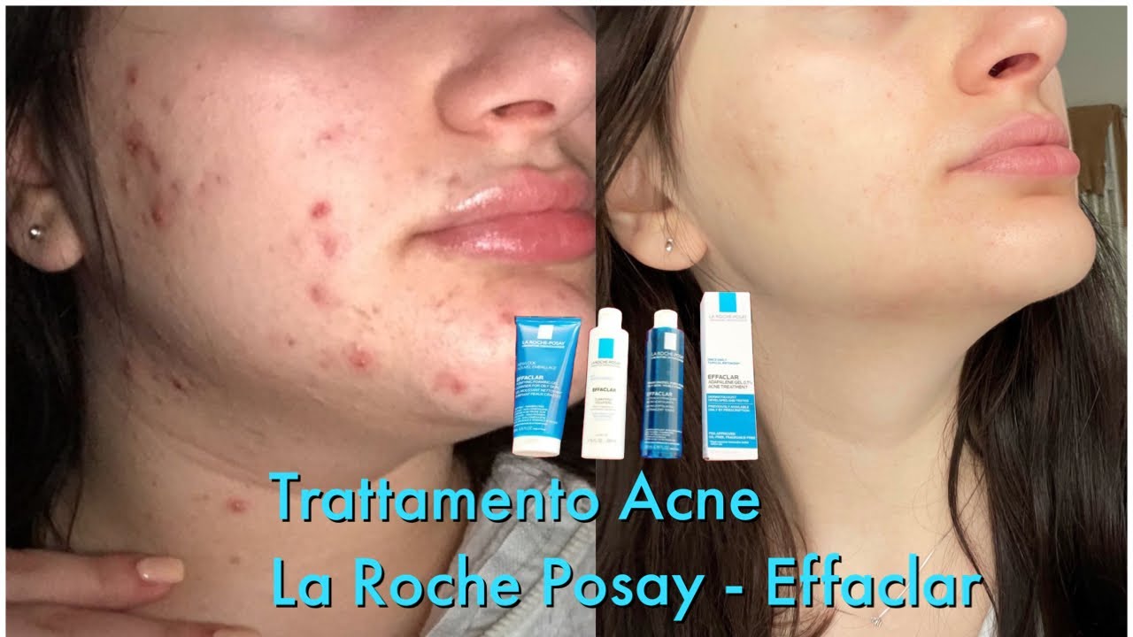 Come ho curato l'acne - acne prima e dopo - La roche Posay Effaclar ...