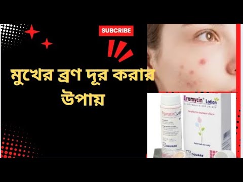 #Eromycin lotion এর কাজ কী? #মুখের ব্রণ দূর করার উপায়#eromycin lotion ...