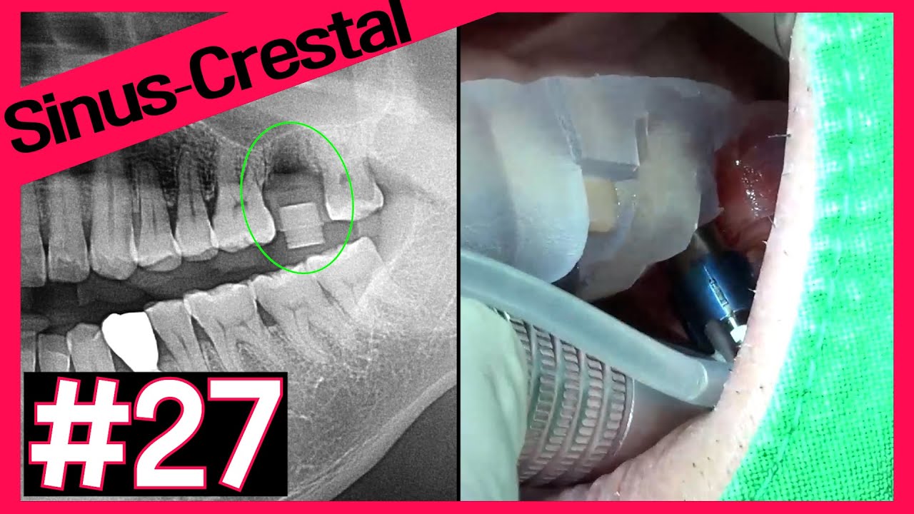 [Online Surgery] New OneCAS KIT를 이용한 #27 식립 - YouTube