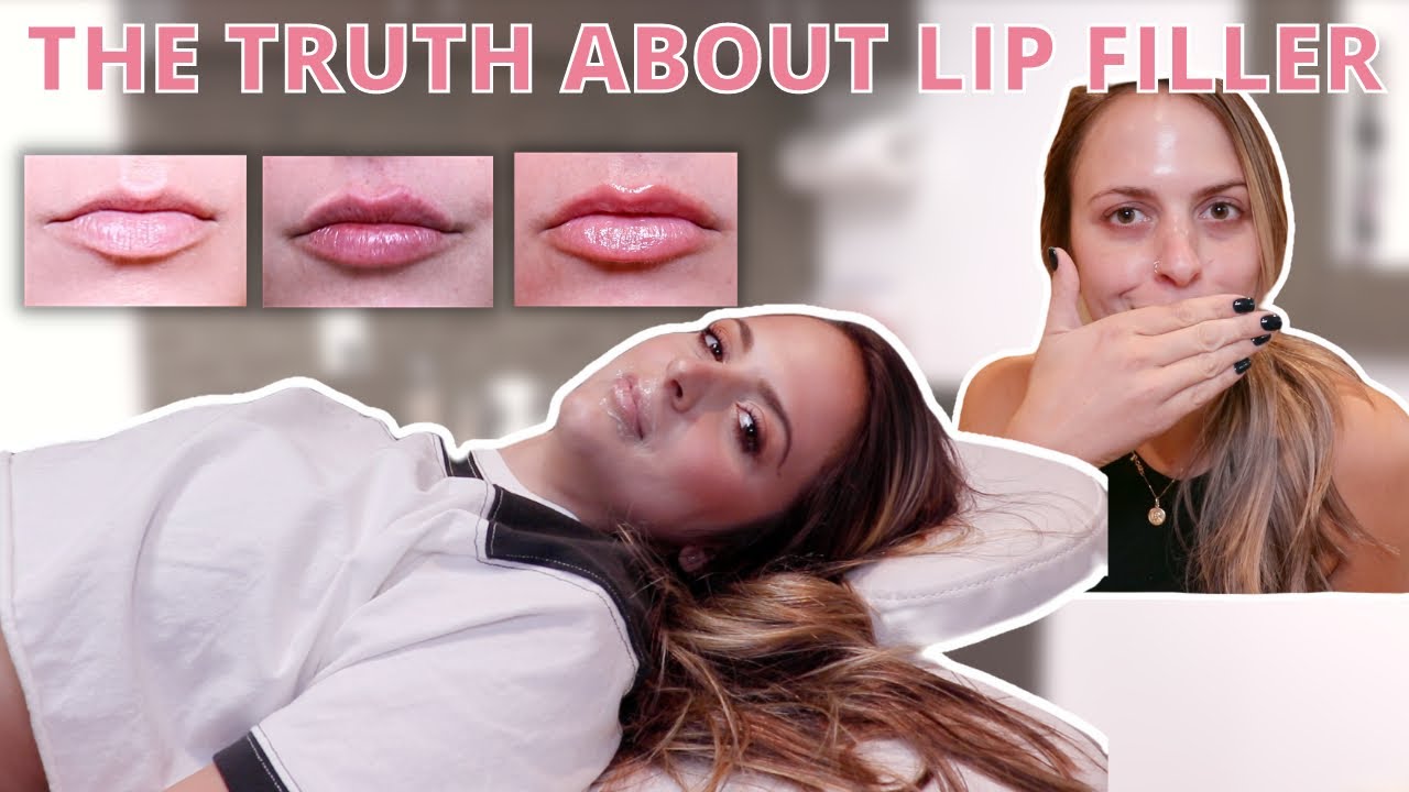 FIRST TIME GETTING LIP FILLER: entire process & healing journey ...