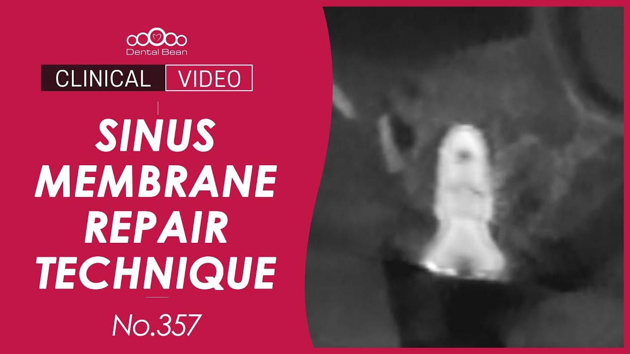 Implant placement with repair of perforated sinus membrane [Dr. Cho ...