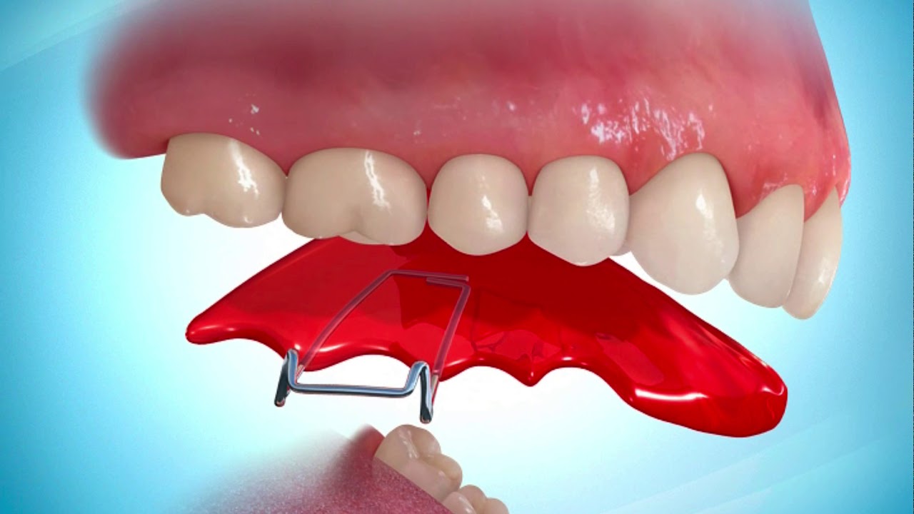 Removable Bite Plate - YouTube