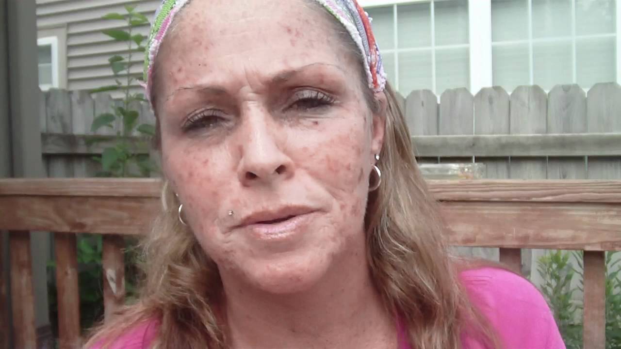 Skin Cancer... My Vlog/ Journal Treatment W/ EFUDEX vid#7 - YouTube