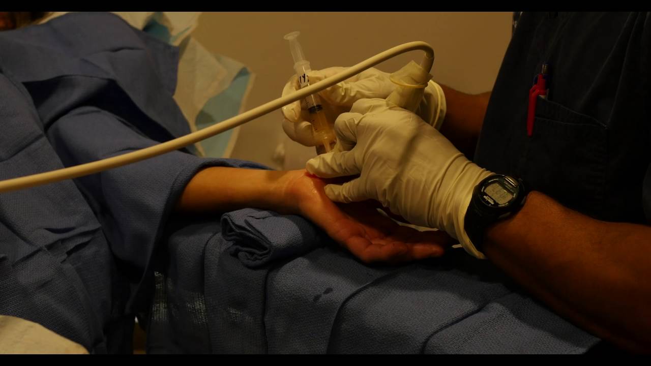 PRP to Treat Hand Arthritis and Trigger Finger - YouTube