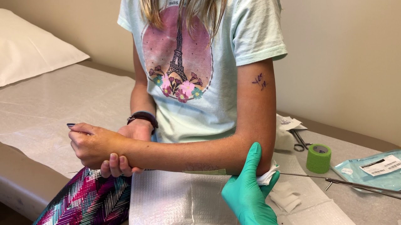 Radius Pin Removal - YouTube