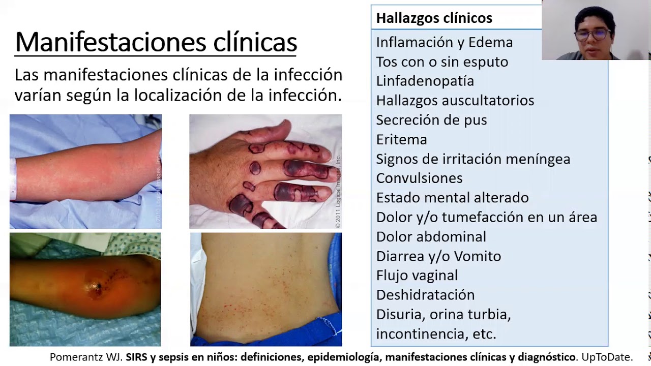 Sepsis y Shock Septico en Pediatria - YouTube