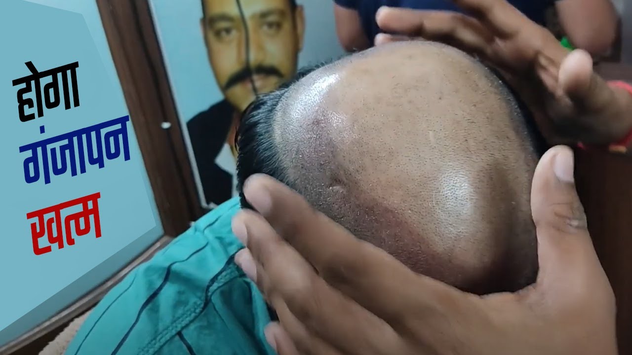 देखते ही देखते होगा गंजापन खत्म Dr Mukesh Aggarwal VHCA - YouTube