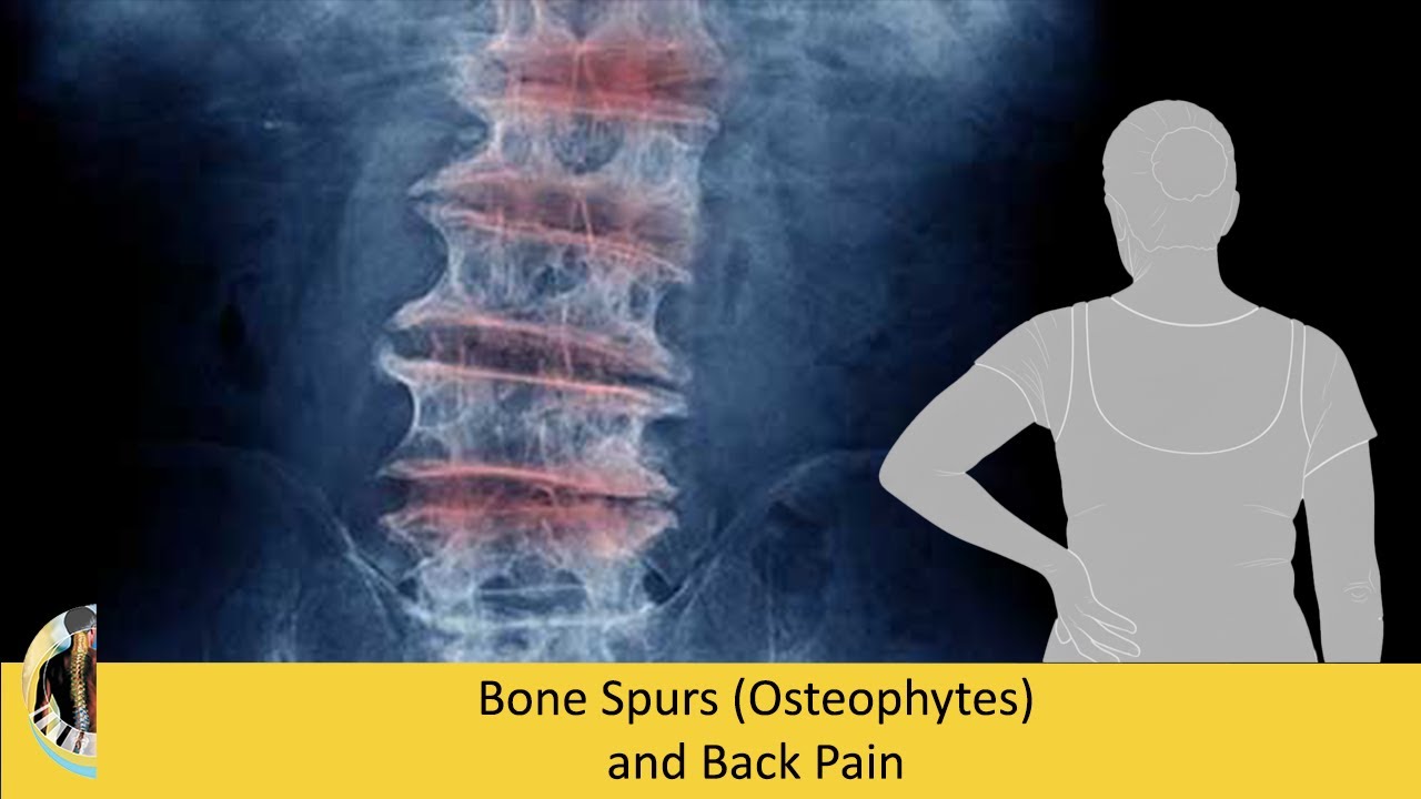 Bone Spurs (Osteophytes) and Back Pain - YouTube