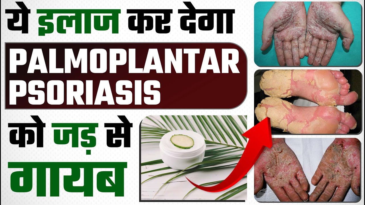 Palmoplantar psoriasis treatment | पालमोप्लांटर सोरायसिस के कारण और ...