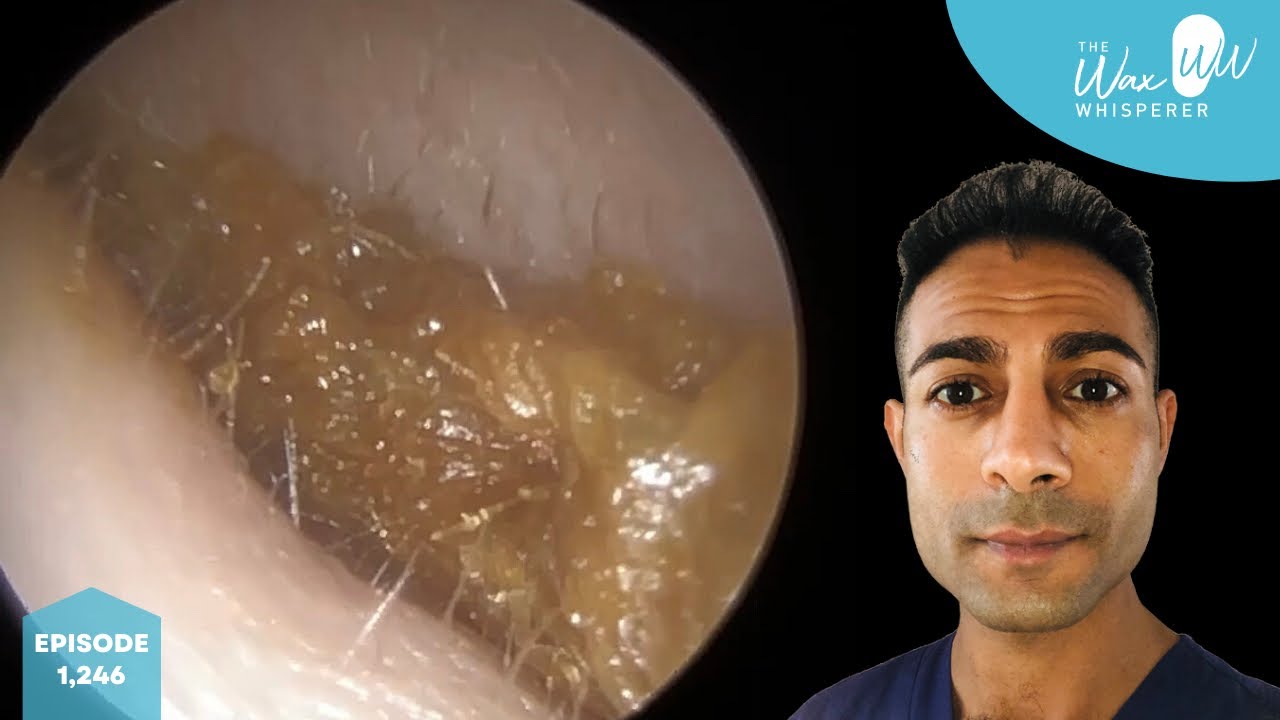 1,246 - Long Dead Skin Ribbons & Soft Ear Wax Removal - YouTube