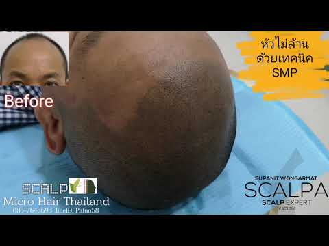 #SMP-No bald anymore with the best technique Thailand by Pafan
