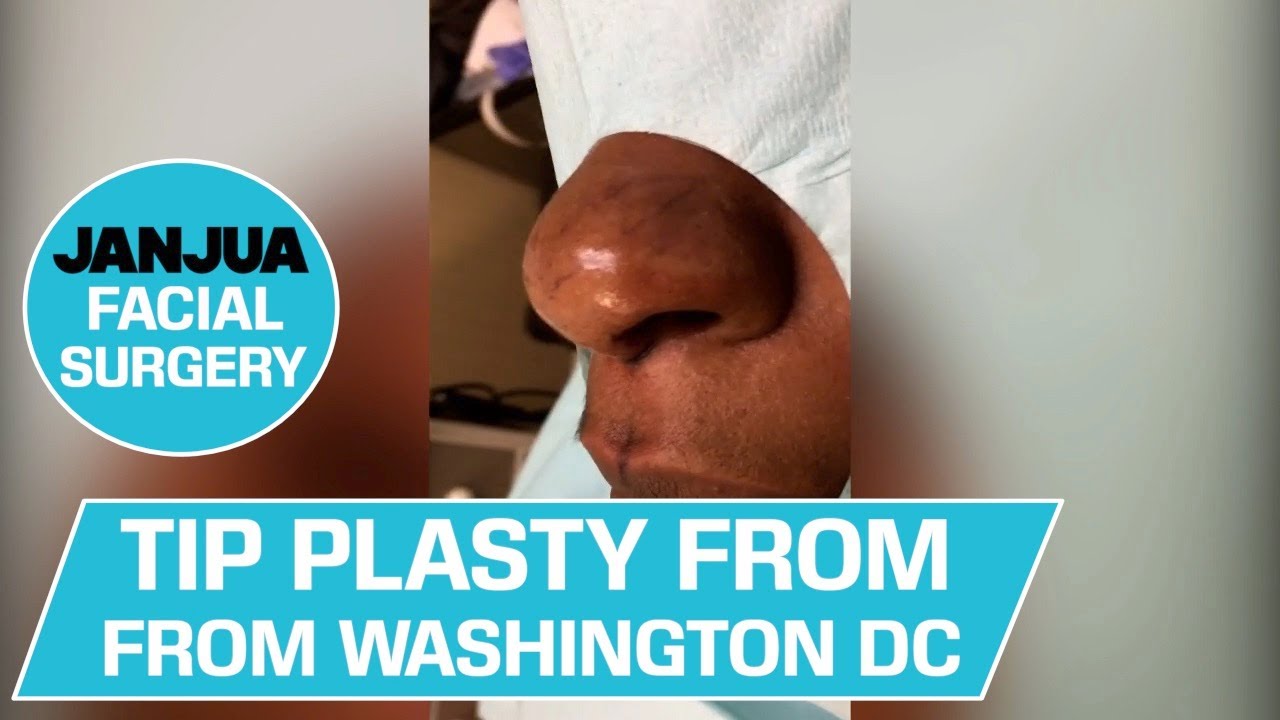 TIP PLASTY FROM WASHINGTON DC - DR. TANVEER JANJUA - NEW JERSEY - YouTube