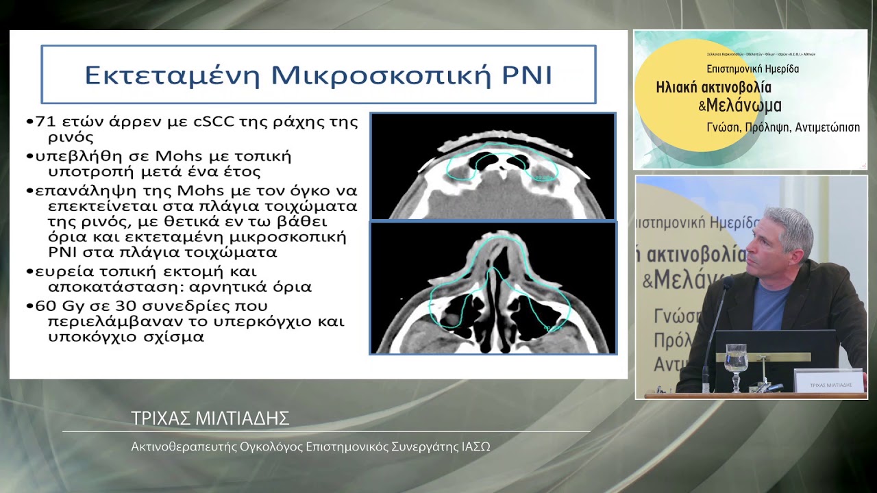 Ο ρόλος της Ακτινοθεραπείας στον δερματικό καρκίνο (ΗΜΕΡΙΔΕΣ Κ.Ε.Φ.Ι ...