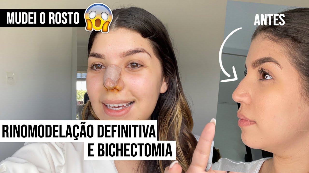FIZ RINOMODELAÇÃO DEFINITIVA E BICHECTOMIA - como foi todo o processo ...