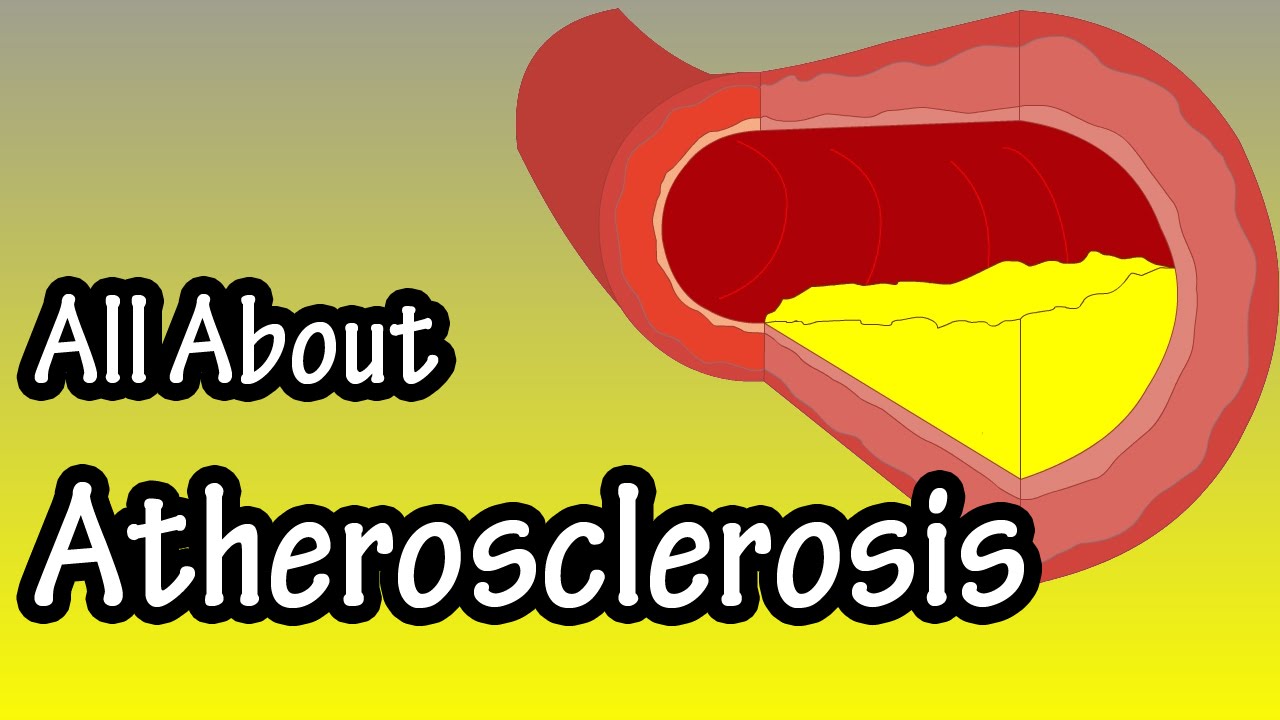 Atherosclerossis Explained - What Is Atherosclerosis - What Is Artery ...