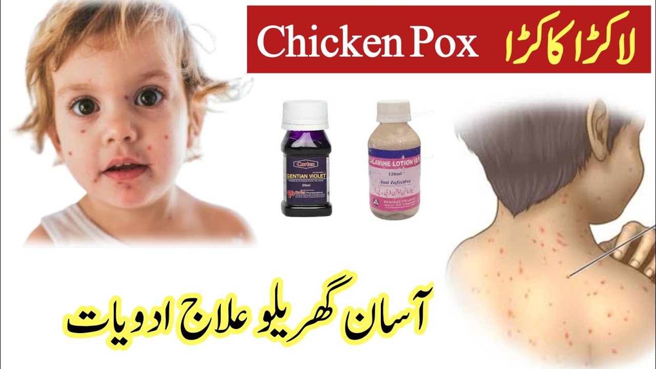 Chickenpox treatment /Chickenpox medicine /Chickenpox ke nishan # ...