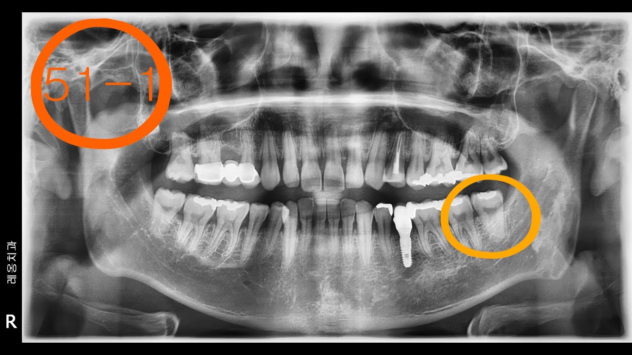 #38 Extraction of vertical impacted wisdom tooth extraction - YouTube