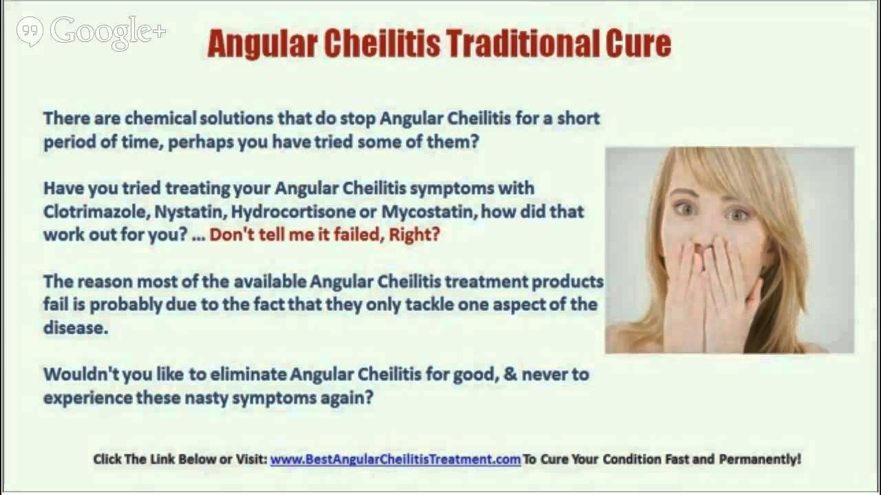 Angular Cheilitis Symptoms - Angular Cheilitis Treatment - YouTube
