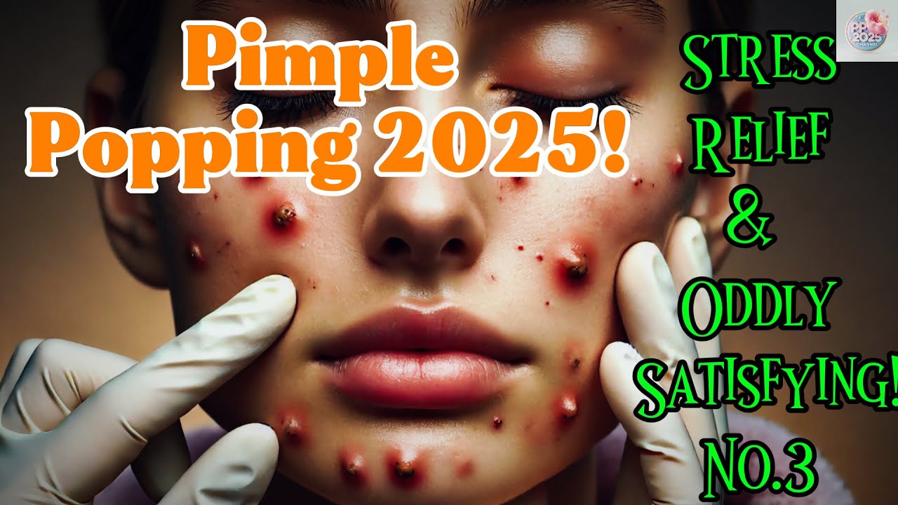 Pimple Popping 2025 – Stress Relief & Oddly Satisfying #3| Pimple ...