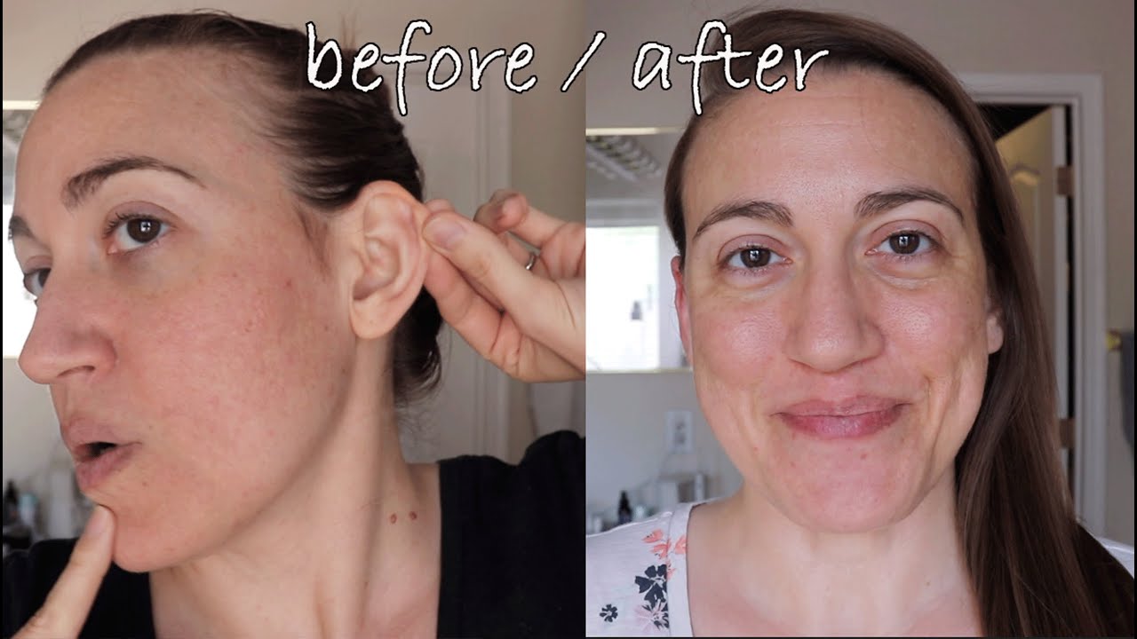 REHABBING MY NEGLECTED SKIN: Day 7 - Healing Damaged Skin and Acne ...