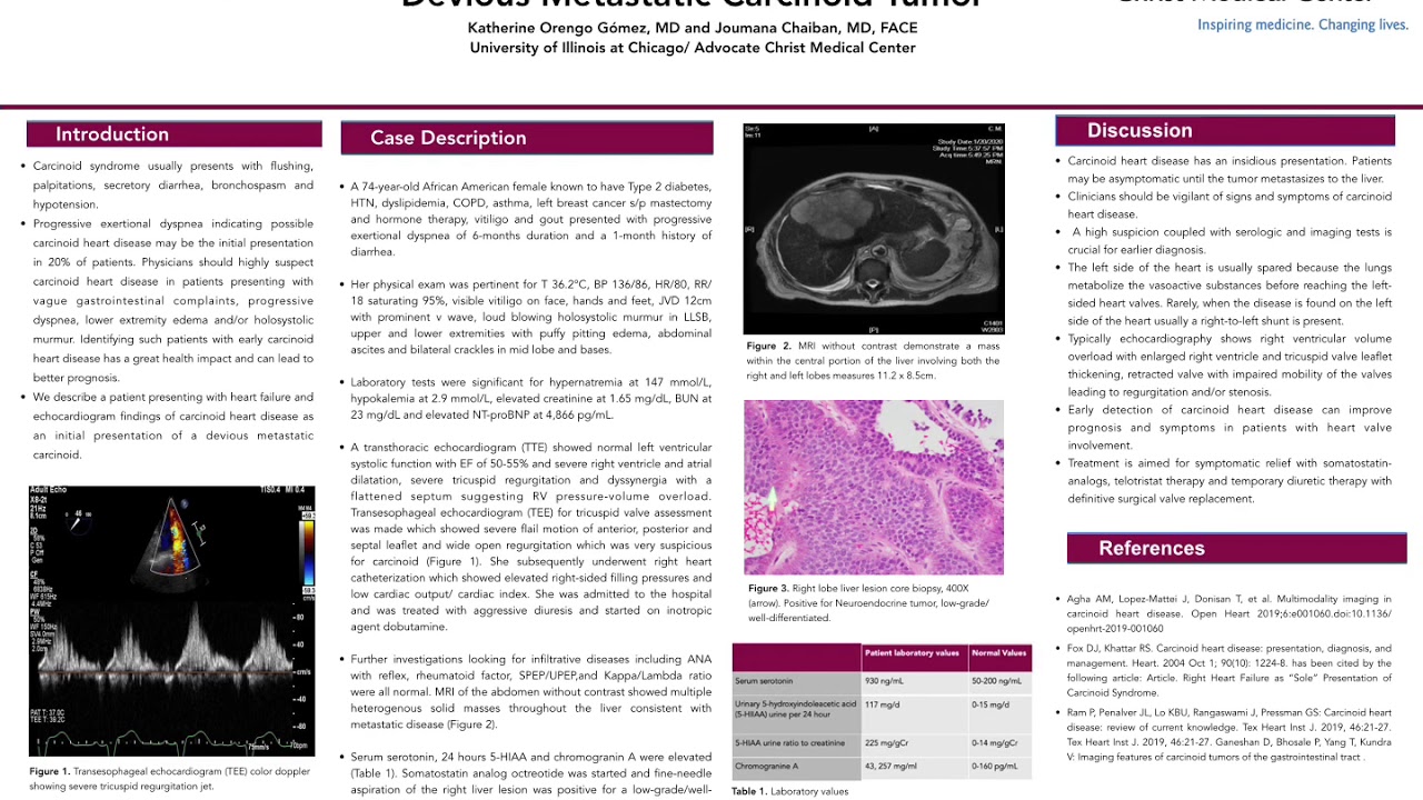 Carcinoid heart disease case presentation - YouTube