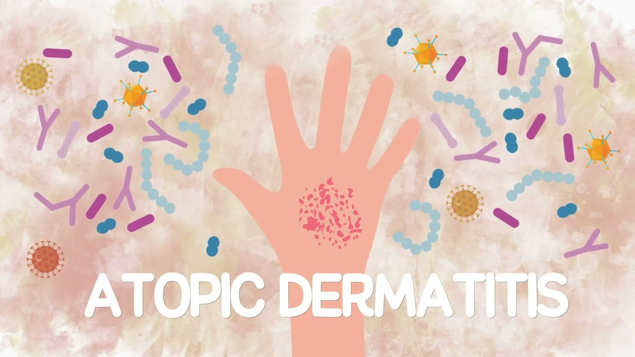 Pathophysiology of Atopic Dermatitis - YouTube