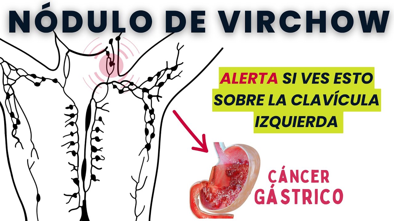 Cáncer Gástrico: Aprende a Identificarlo con el Nódulo de Virchow ...