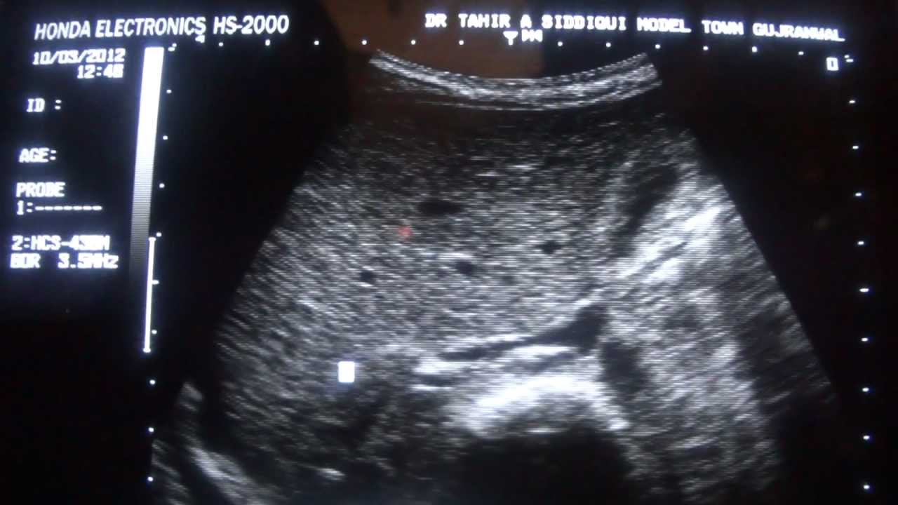 ULTRASOUND RENAL PATHOLOGY part 2 of 3 - YouTube