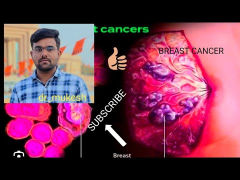 Breast cancer/कैंसर by dr_mukesh - YouTube